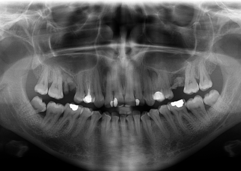 Panoráma röntgen - 360 Dental Fogászat és Szájsebészet Budapest ...