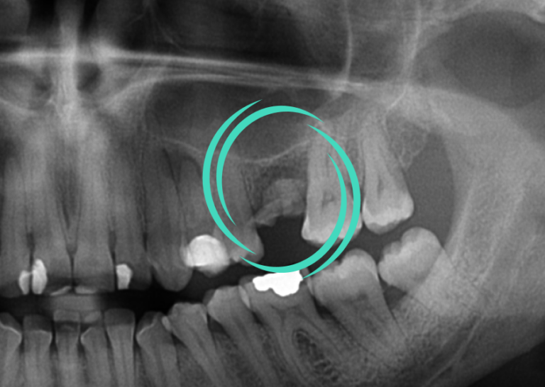 Panoráma röntgen - 360 Dental Fogászat és Szájsebészet Budapest ...
